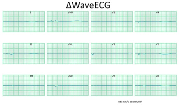 New CineECG delta map article published - ECG-Excellence