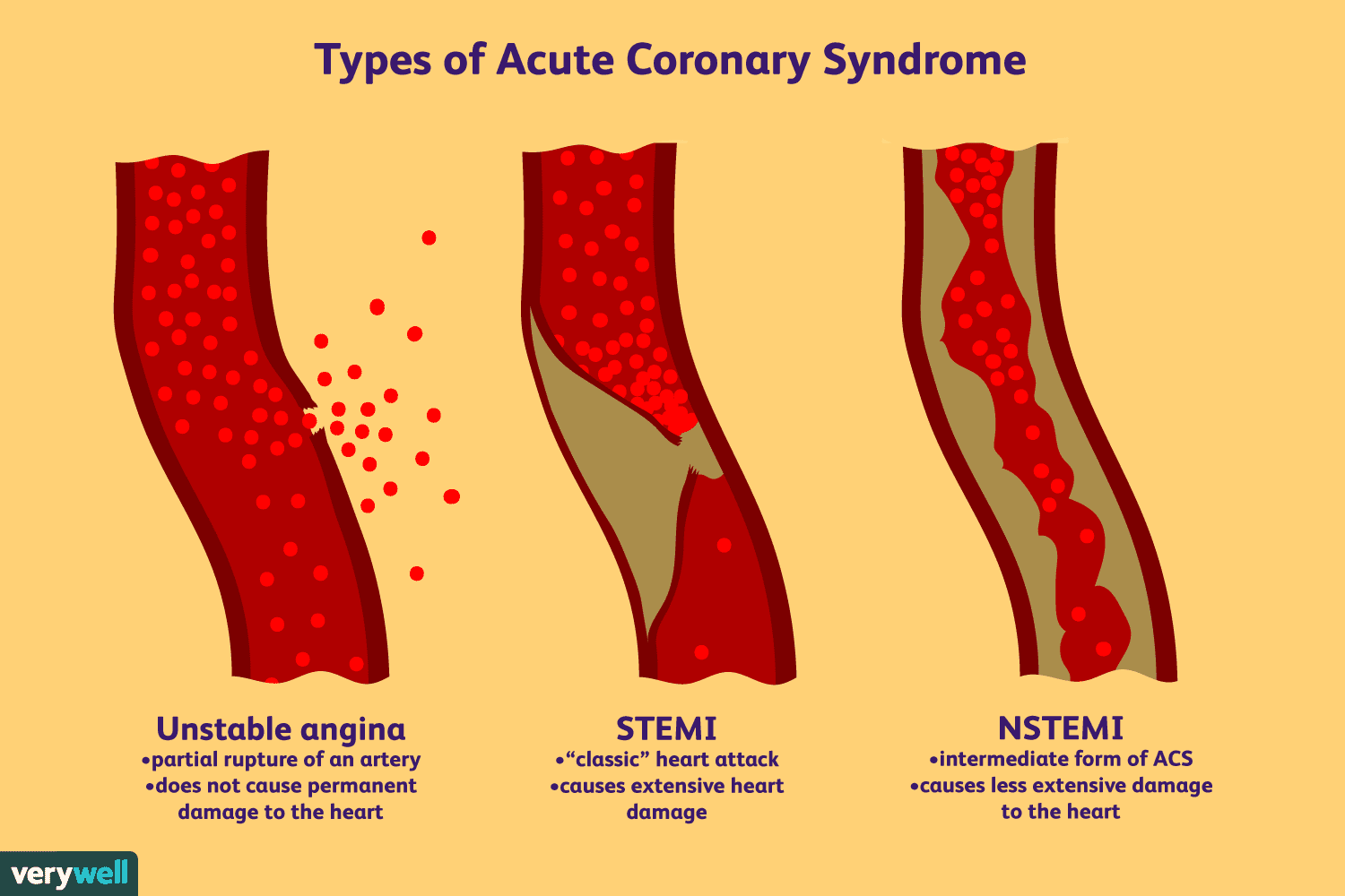 ECG And STEMI Criteria ECG Excellence ECG And STEMI Criteria ECG Excellence