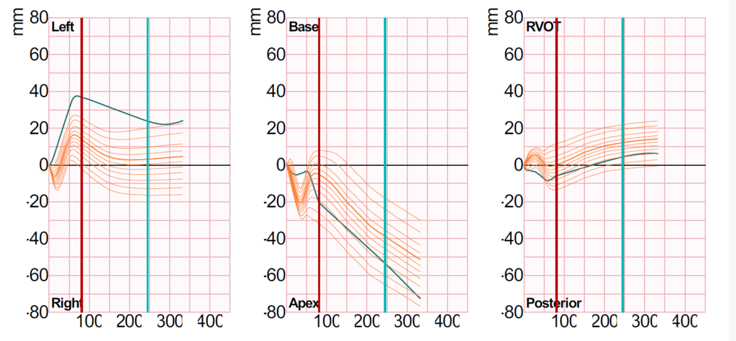 Mistakes in ECG interpretation - ECG-Excellence