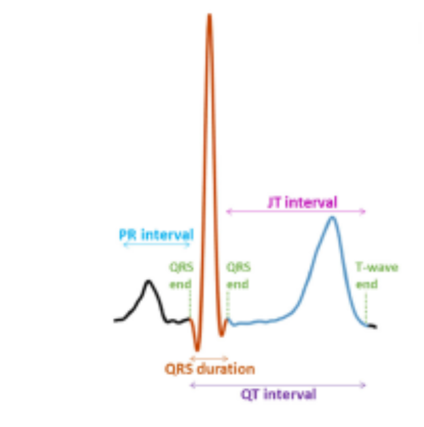 Spatial QRS-T angles to indicate CVD risk - ECG-Excellence
