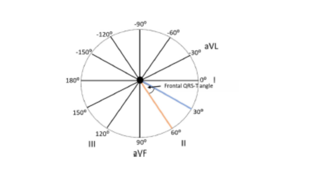 Spatial QRS-T angles to indicate CVD risk | ECG-Excellence