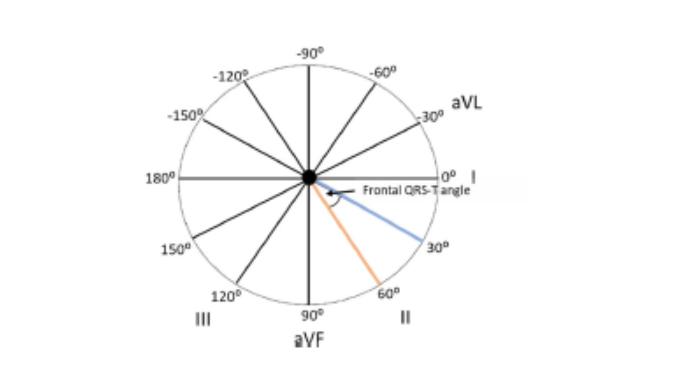 Spatial QRS-T angles to indicate CVD risk - ECG-Excellence
