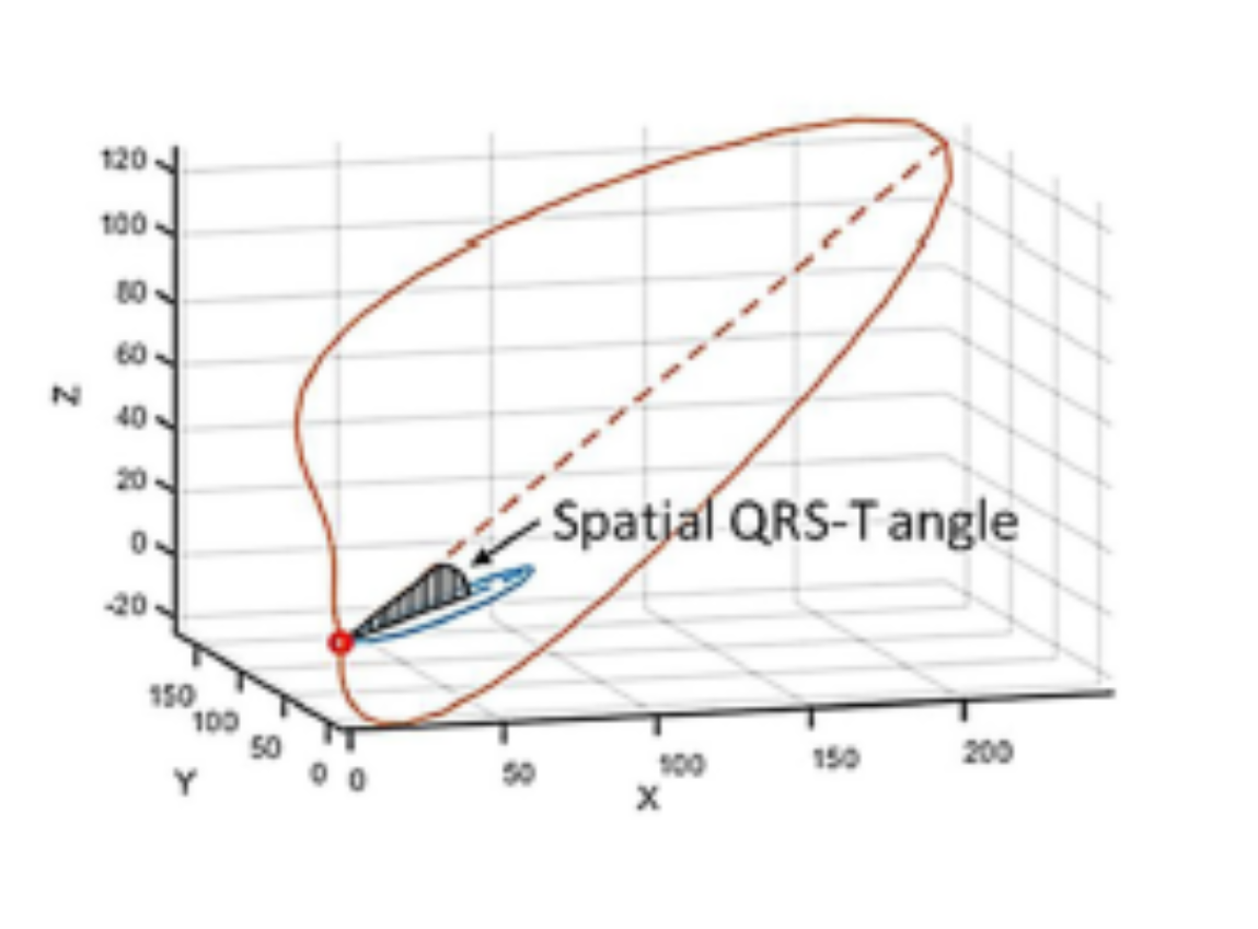 Spatial QRS-T angles to indicate CVD risk - ECG-Excellence
