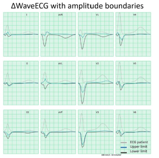ECG waveforms tell more than amplitudes - ECG-Excellence