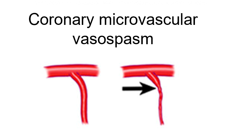 Coronary vascular dysfunction - ECG-Excellence