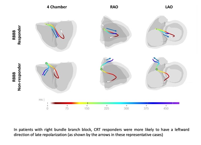 Improving CRT response - ECG-Excellence