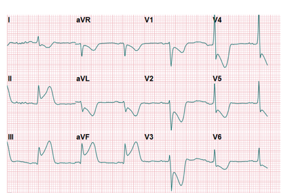 Inferior wall infarction - ECG-Excellence
