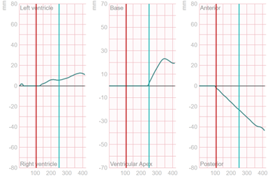 Inferior wall infarction - ECG-Excellence