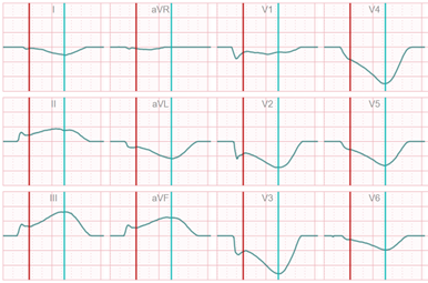 Inferior wall infarction - ECG-Excellence