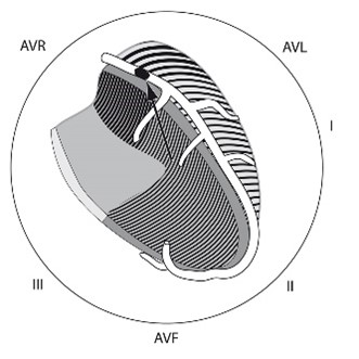 Extensive anterior wall infarction - ECG-Excellence