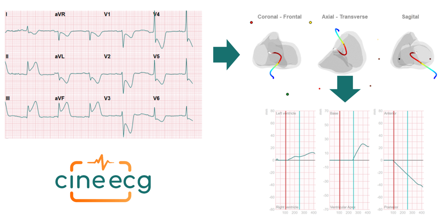 Inferior wall infarction - ECG-Excellence