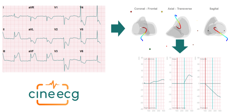 Inferior wall infarction - ECG-Excellence