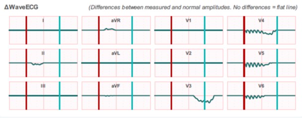 Anyone can interpret 12-lead ECG - ECG-Excellence